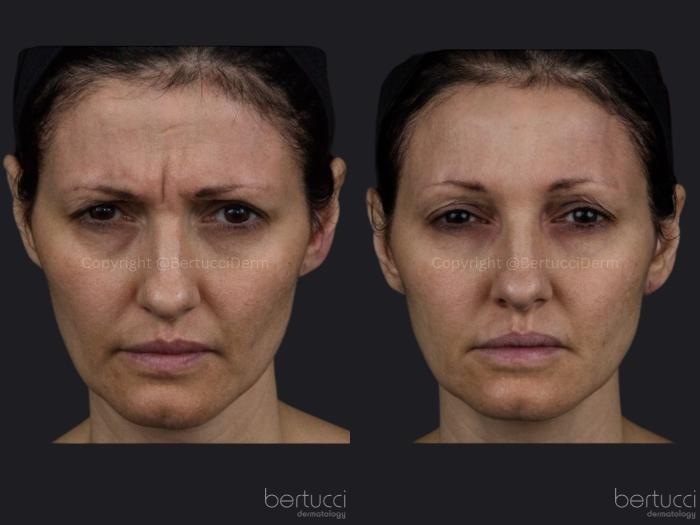 BOTOX® Cosmetic & Other Neuromodulators Before & After Pictures Case 16 ...
