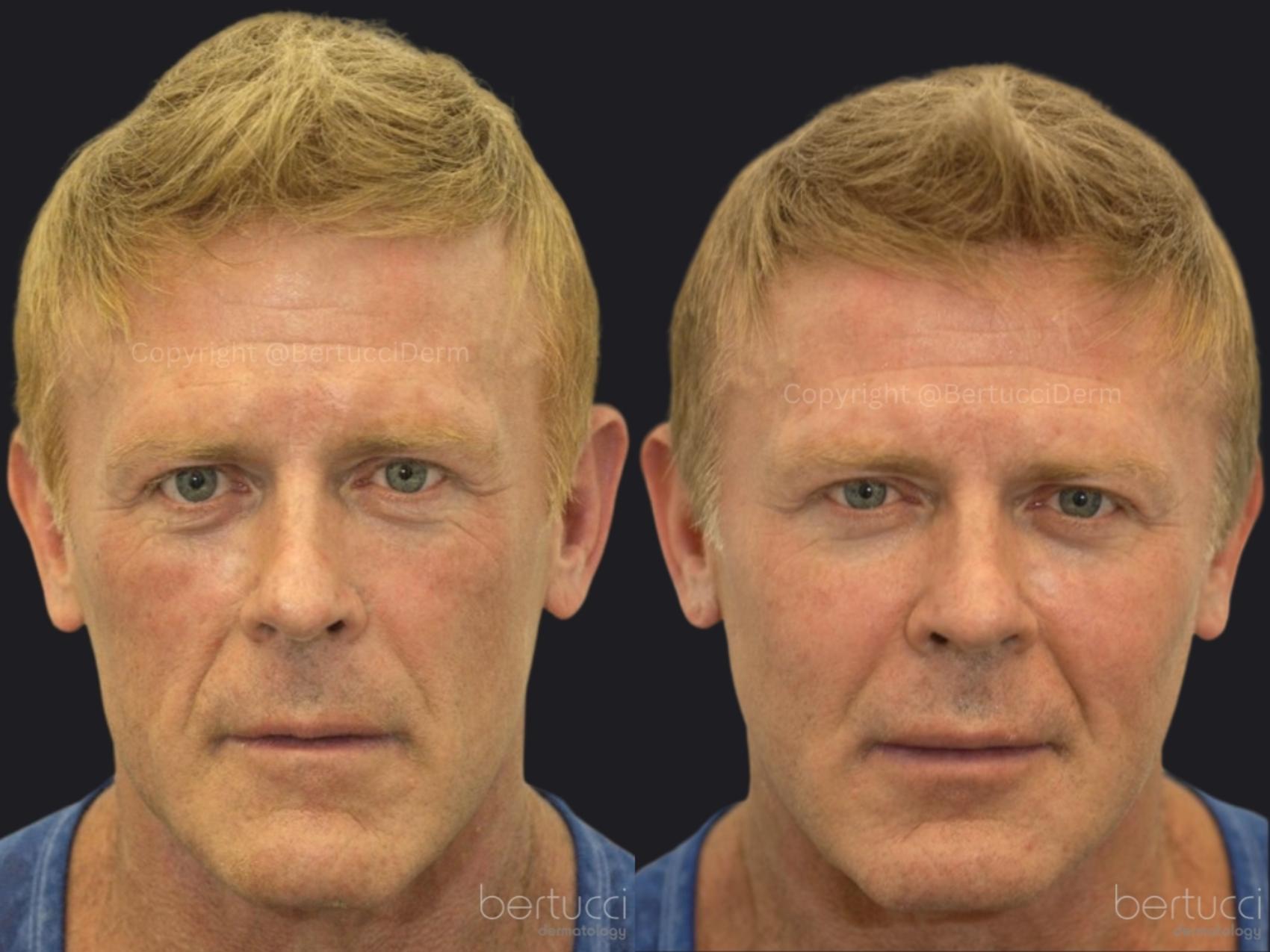 Full Face Rejuvenation Before & After Pictures Case 14 | Woodbridge ...