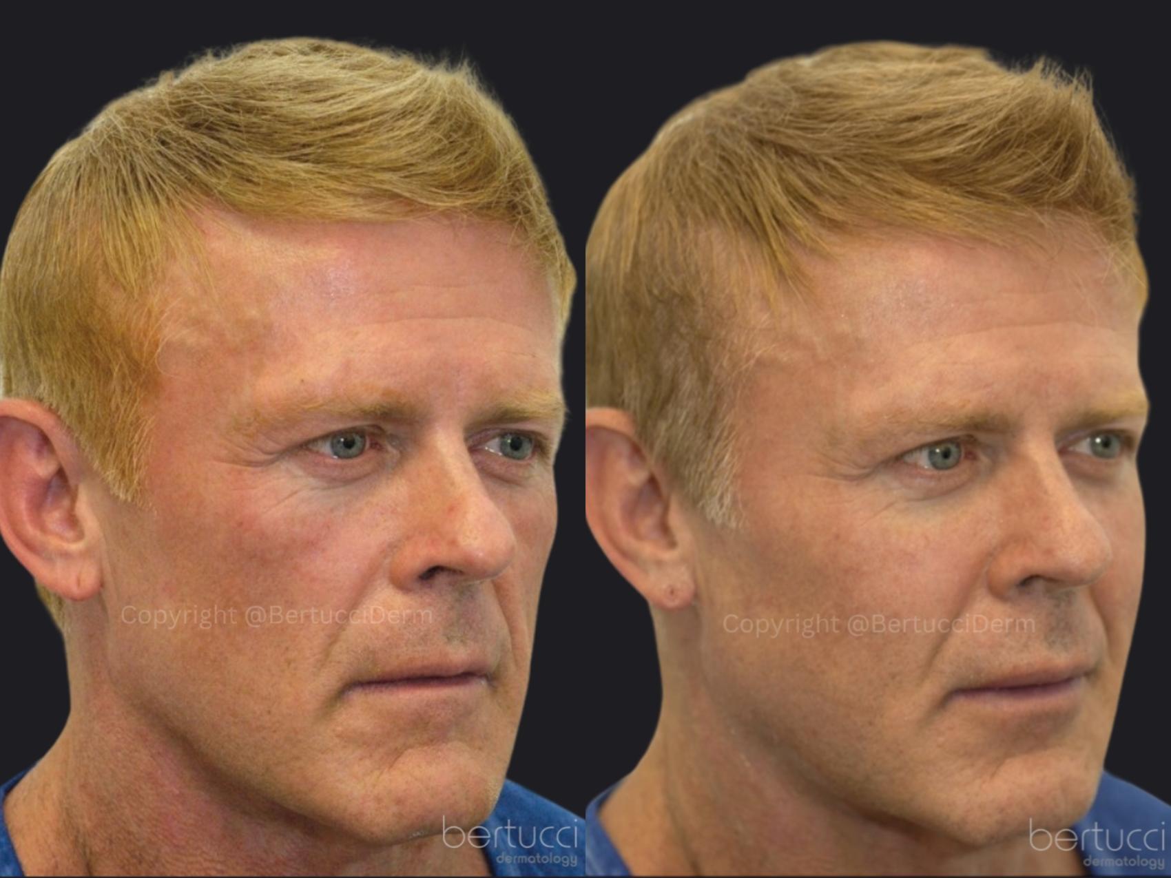 Full Face Rejuvenation Before & After Pictures Case 14 | Woodbridge ...