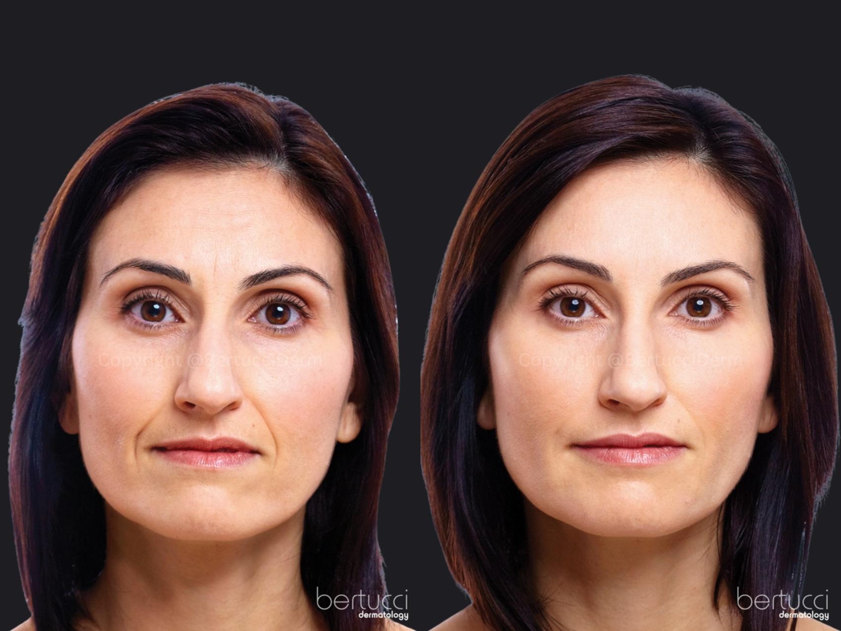 Full Face Rejuvenation Before & After Pictures Case 18 | Woodbridge ...